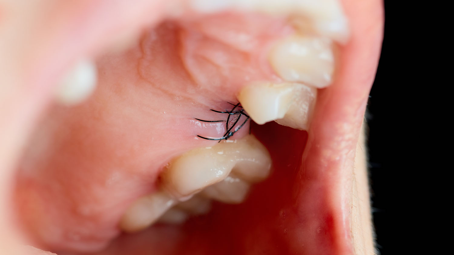 How Long Does It Take Gums To Heal After A Tooth Extraction How Long Does It Take Gums To Heal After A Tooth Extraction